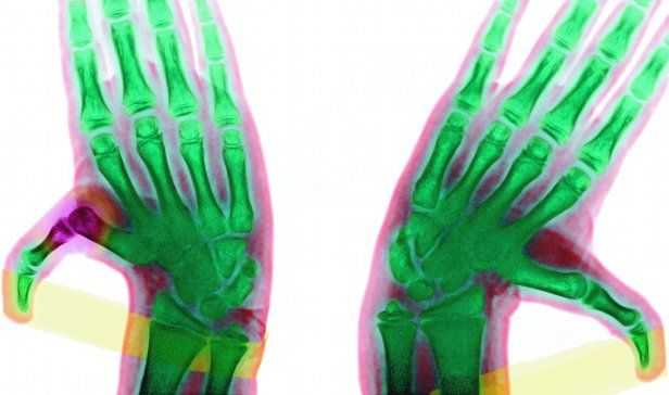 Why are some people double-jointed? | How It Works