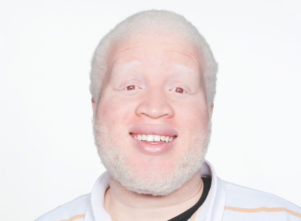 Understanding albinism | How It Works
